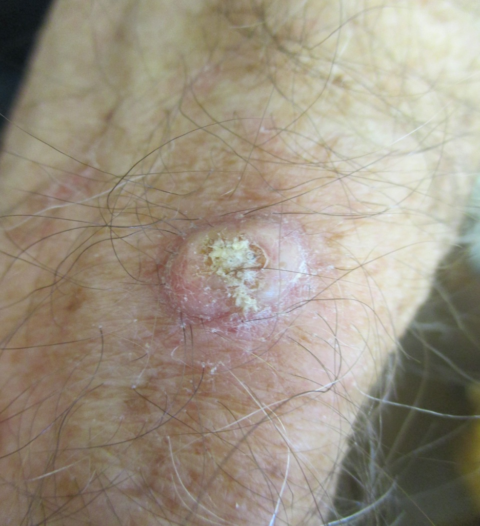An Atlas of Lumps and Bumps, Part 29: Keratoacanthoma | Consultant360